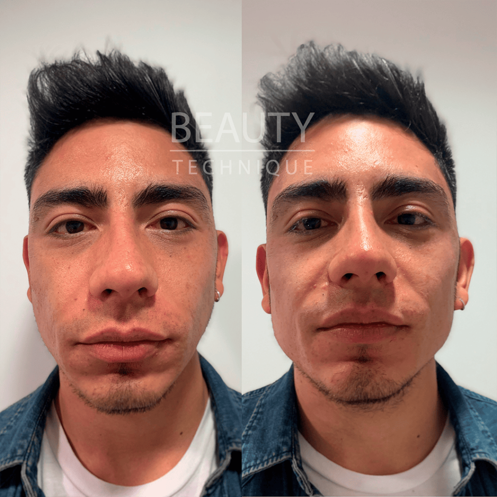 Relleno de Contorno Mandibular – Beauty Technique