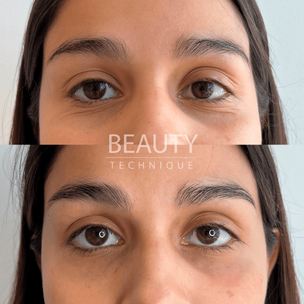 Ácido hialurónico ojeras – Beauty Technique