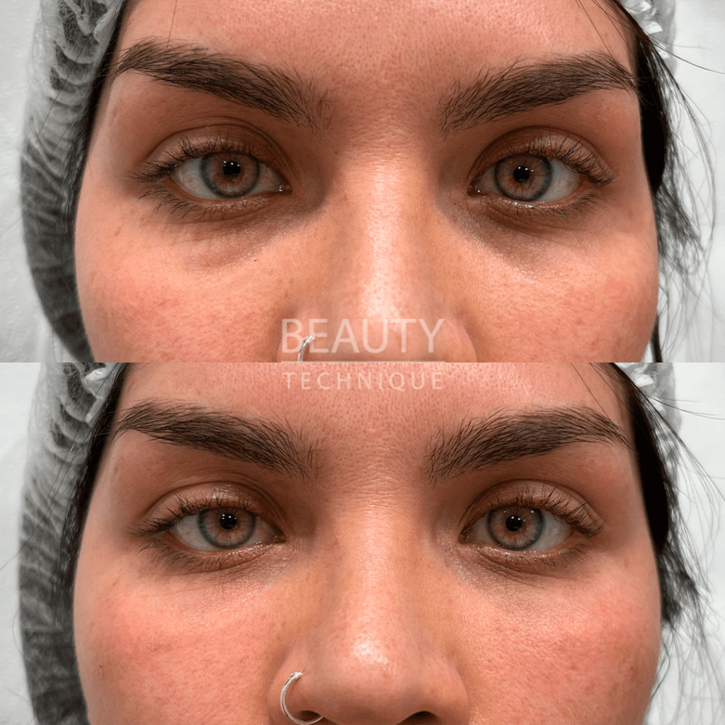 Ácido hialurónico ojeras – Beauty Technique