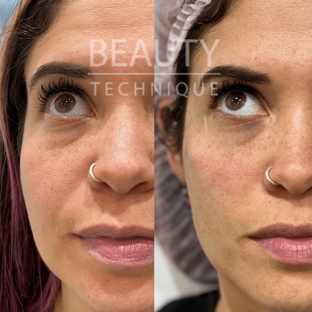 Relleno de Pómulos – Beauty Technique