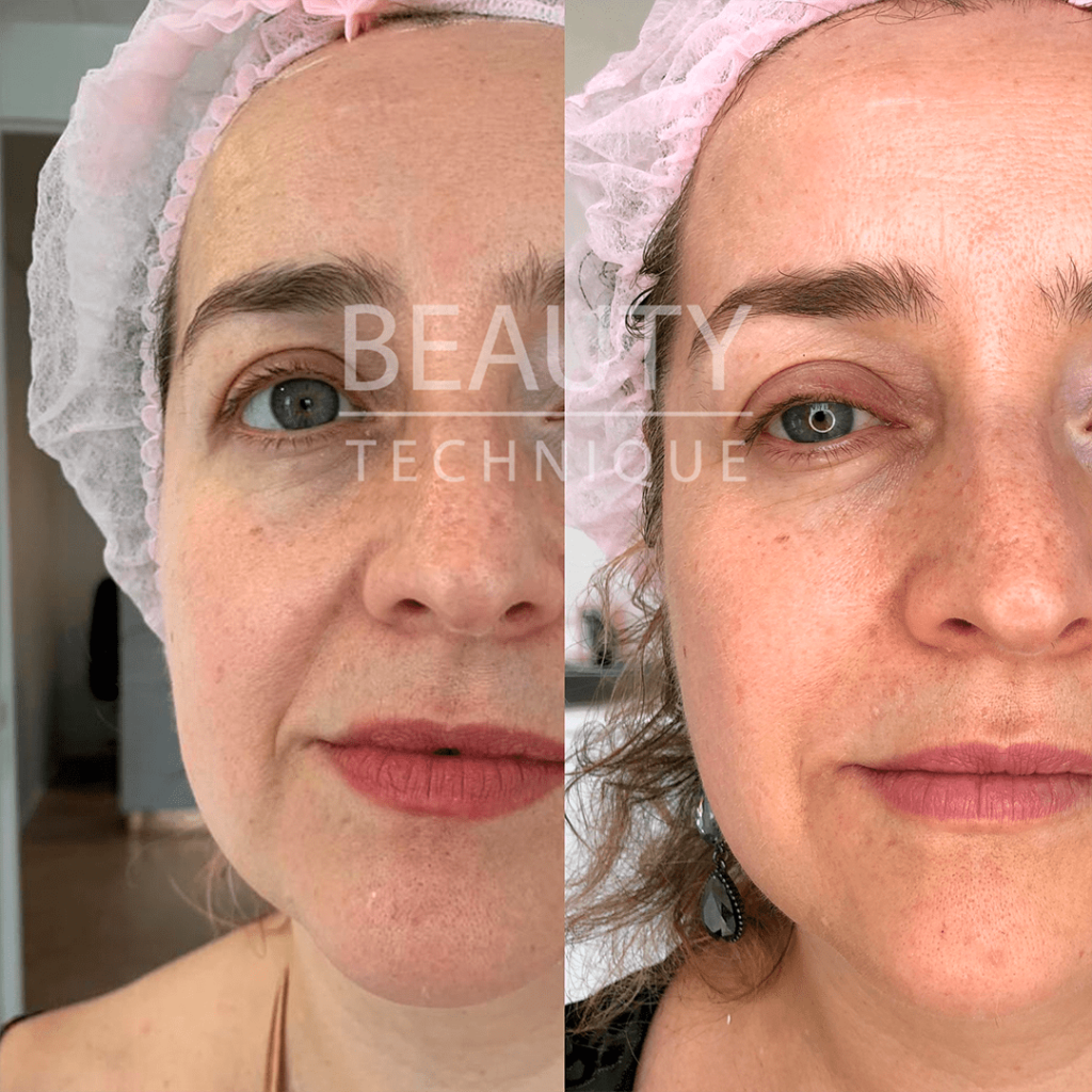 Relleno de Pómulos – Beauty Technique